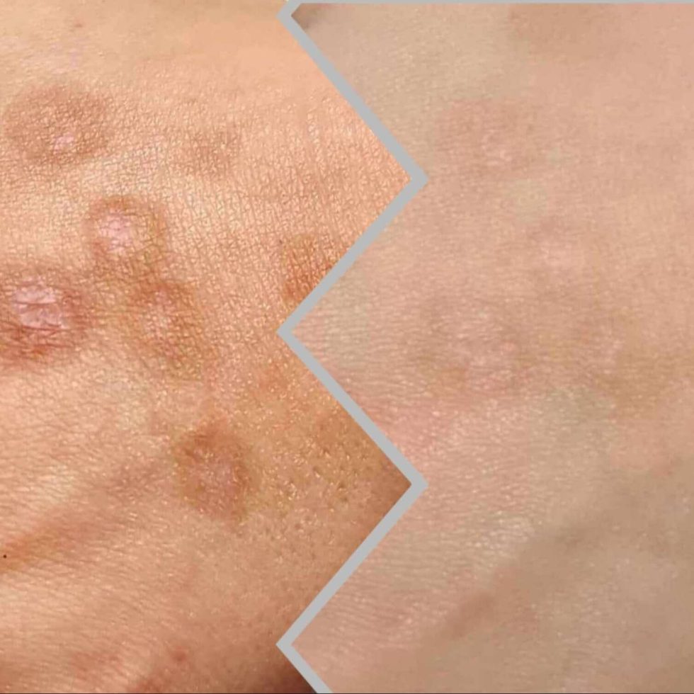 Burn Scar Laser Treatment Effective Results | Elipsa